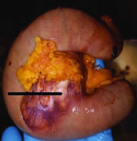 A Resected Segment Of The Jejunum With The Tumor Black Arrow Ct