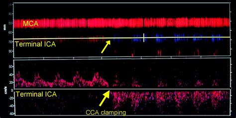 Transcranial Doppler Monitoring Of Transcervical Carotid Stenting With