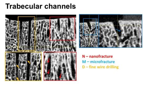 Marrow Access Technologies On Linkedin Orthopedicsurgery Orthopedics
