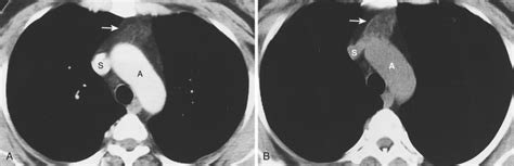 Mediastinal Disease Clinical Tree
