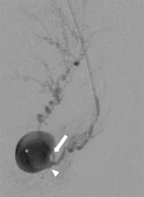 Angiographic Images A An Angiogram Reveals A Pseudoaneurysm Located