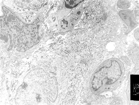 Soft Tissue Sarcoma Free Photos On