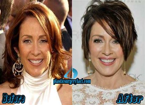 Patricia Heaton Prima E Dopo Patricia Heaton Plastic Surgery Photos