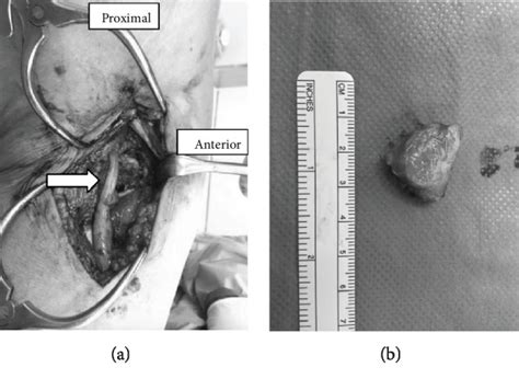 Late Onset Of The Fabella Syndrome After Total Knee Arthroplasty Pmc