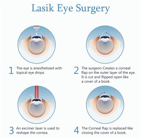 Laser Surgery Procedure