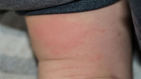 Rash 22 Common Skin Rashes Pictures Causes Treatment Artofit