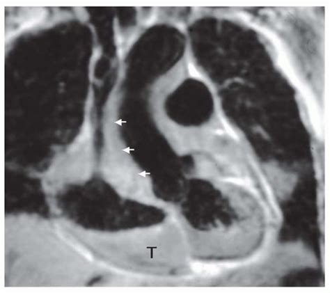Cardiac And Paracardiac Masses Radiology Key