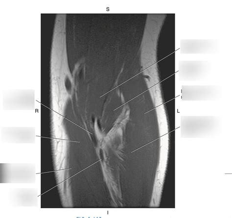 Coronal Mri Thumb Planning At Brodie Hannell Blog