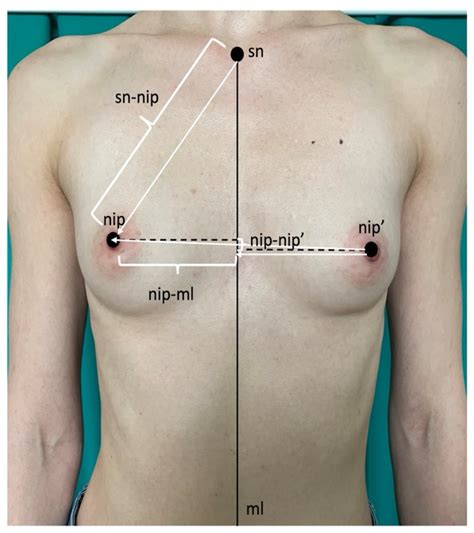 Breast Fluctuating Asymmetry In Women With Macromastiagigantomastia