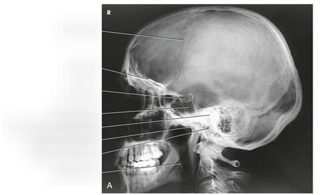 Lateral Cranium Diagram Quizlet