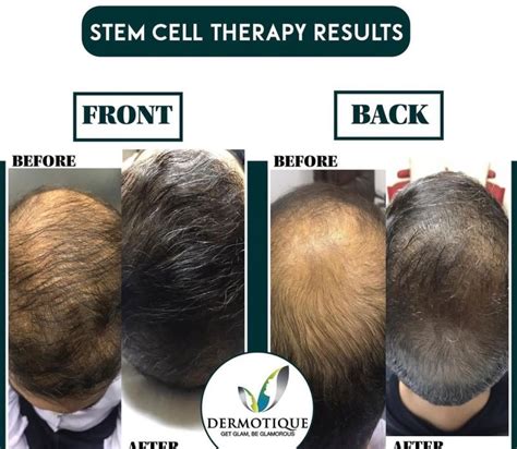 Regenerativemedicine Stemcells Aesthetics Dermatologist Dr Junaid Yousaf