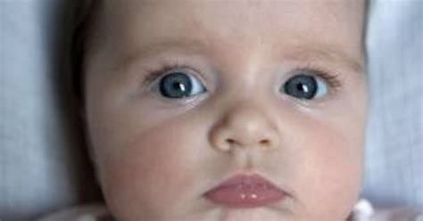 Strabisme Une Prise En Charge Précoce Simpose