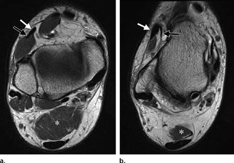 Pitfalls Of Mr Imaging Of The Edl Tendon In A 46 Year Old Man Axial