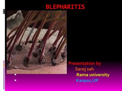 Blepharitis Pptx