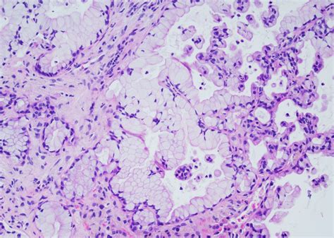 Mucinous Tumors Pancreas