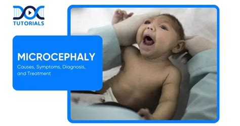 Microcephaly Causes Symptoms Diagnosis And Treatment