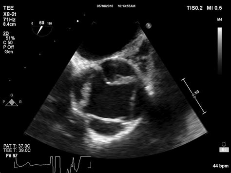 Two Dimensional Transesophageal Echocardiographic Image Showing