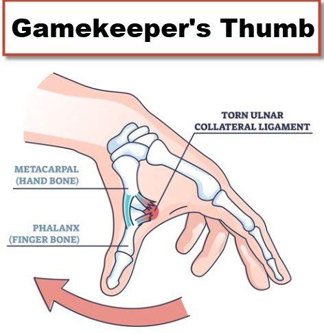 Gamekeepers Thumb Jacksonville Orthopaedic Institute