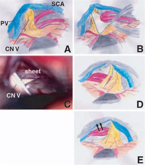 Figure 1 From Microvascular Decompression Of Cranial Nerves Using