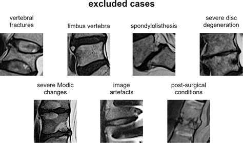 Excluded Cases In The Selection Of The Intervertebral Spaces