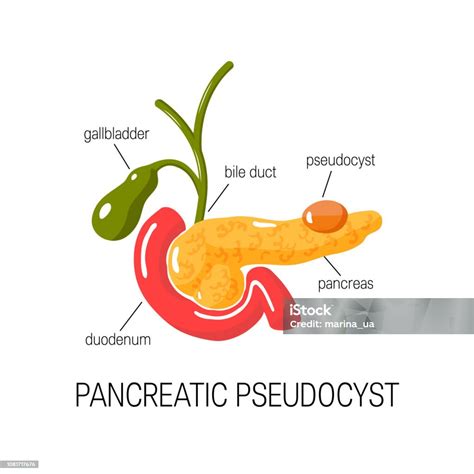 Pancreatic Pseudocyst Concept Vector Illustration Stock Illustration
