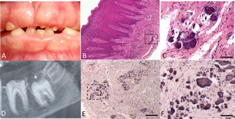 Gingival And Dental Follicle Ectopic Calcifications In Patients With