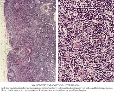 Pathology Outlines Follicular Hyperplasia