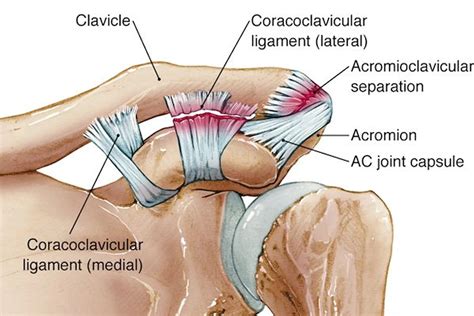 Acromioclavicular Joint Dislocation Op Dr M Tibet Altuğ