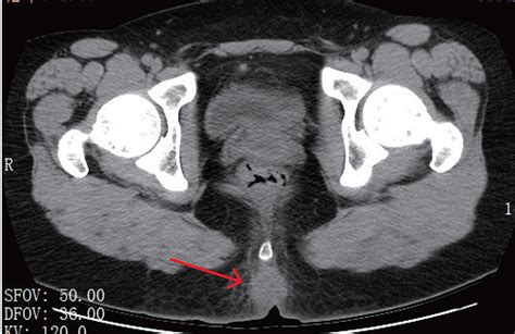 Case Report A Rare Case Of Pilonidal Abscess Caused By Coinfection Of