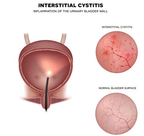 Health Facts About Interstitial Cystitis Activebeat Your Daily Dose