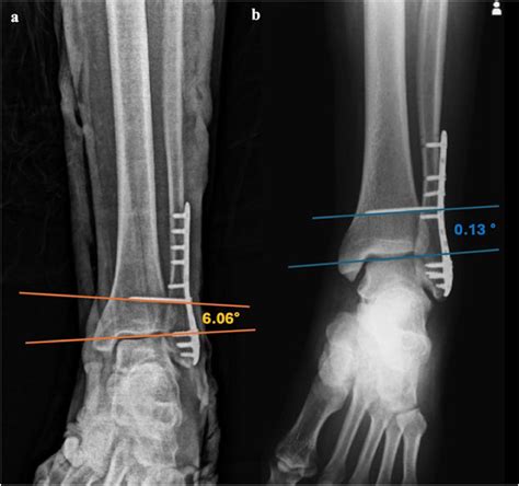 Evaluation Of The Clinical And Radiological Outcomes Of Syndesmotic