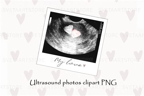 Ultrasound Clipart Black And White