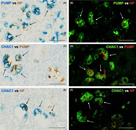 Chac1 Overexpression In Human Gastric Parietal Cells With Helicobacter Pylori Infection In The