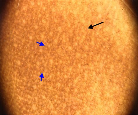 Pigmented Contact Dermatitis Patchy Accentuation Of Pigment Network