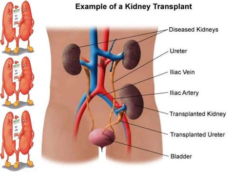 Ckd Ppt Copypptx Presentations Of Ckd Ppt