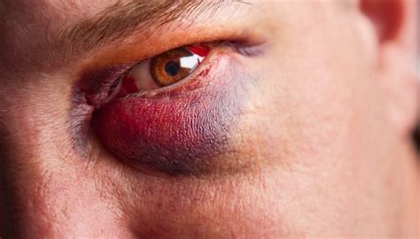 How Long Does A Black Eye Last Healing And Treatment Guide