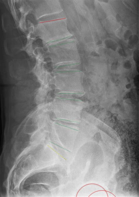 Minimally Invasive Transforaminal Lumbar Interbody Fusion Prof Aaron