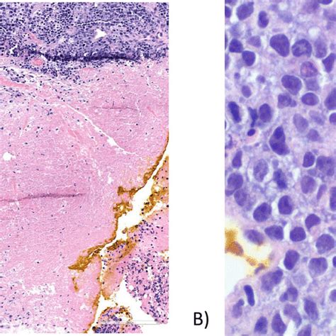 A Axillary Lymph Node 4 × Hande Stain Needle Core Biopsy With Areas Of Download Scientific