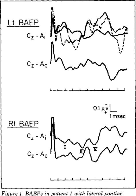 Figure 1 From Lateralization Of Brainstem Lesions By Brainstem Auditory
