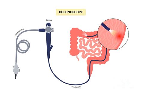 Colonoscopy Procedure 4 Photograph By Pikovit Science Photo Library Pixels