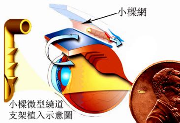 青光眼微创手术的最新进展林顺潮爱问健康