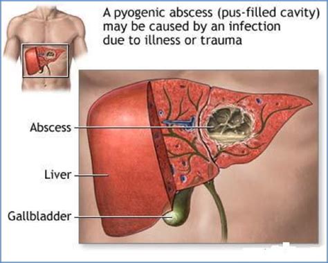 Liver Abscesses Gastrointestinal Medstudentnotes