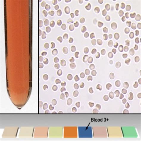 Urine Cell Id Quiz Flashcards Quizlet