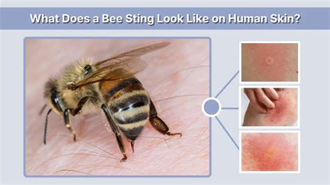 What Does A Bee Sting Look Like Identification With Pictures
