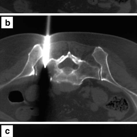 Percutaneous Osteoplasty Surgical Procedure For The Treatment Of A