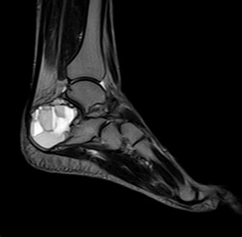 Pathology Outlines Aneurysmal Bone Cyst Pathology Outlines Aneurysmal Bone Cyst