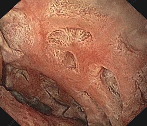 Malt Lymphoma In The Duodenum Stock Image C009 6829 Science Photo Library