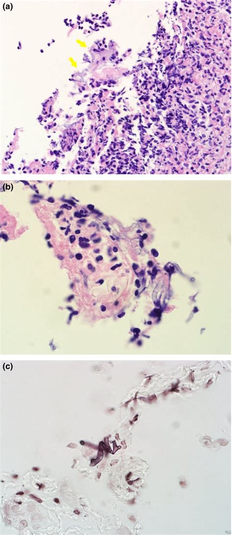 Pseudozyma Aphidis Fungaemia With Invasive Fungal Pneumonia In A