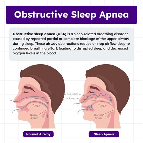 Obstructive Sleep Apnea Overview And Practice Questions