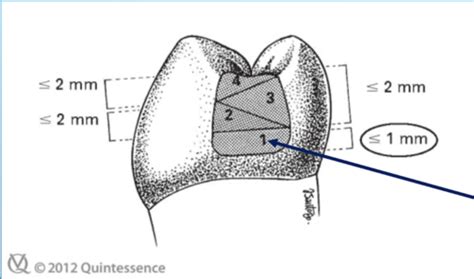 Lecture 21 Posterior Composite Class Ii Restorations Flashcards Quizlet